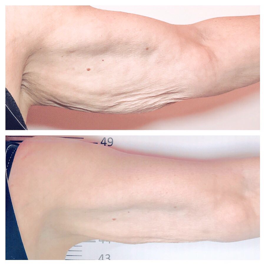 Endermologie – Smooth Cellulite, Firm Skin - House of Beauty